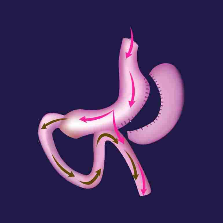 SASI Surgery in Egypt - Dr Osama Khalil Clinic